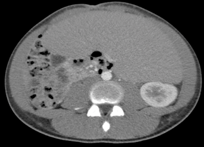 A Unique Case of Chronic Myeloid Leukemia Occurring in an Adolescent ...