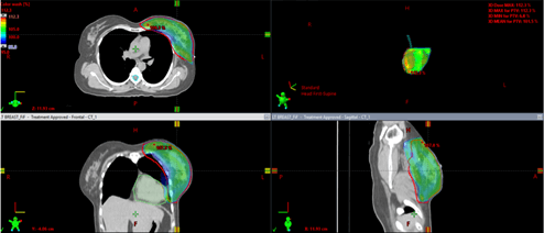 Deep-Inspirational Breath-Hold (DIBH) Technique in Left-Sided Breast ...