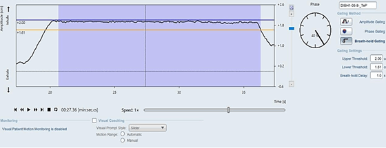 Deep-Inspirational Breath-Hold (DIBH) Technique in Left-Sided Breast ...