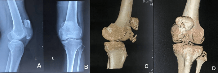 Pathologic Fracture of The Patella Secondary to a Gouty Tophus ...