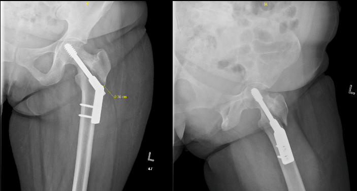 A Case of Two Consecutive Peri-Implant Fractures After Treatment of an ...