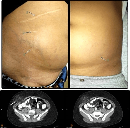 Laparoscopic Appendectomy Incision Sites