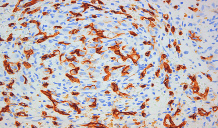 De Novo Angiosarcoma of the Thoracic Outlet: A Rare Entity | Surgical ...