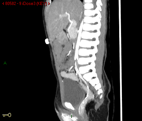 Hematochezia in a 1.5-Year-Old Child Diagnosed as a Colonic ...