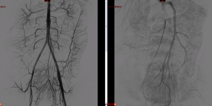 Hematochezia in a 1.5-Year-Old Child Diagnosed as a Colonic ...