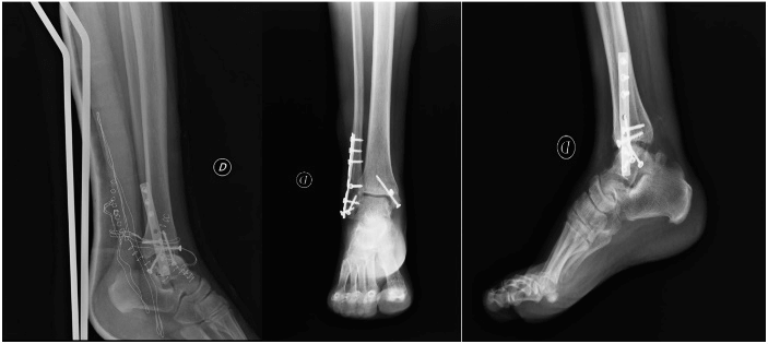 Complex Ankle Fractures, Presentation of 3 Cases and Review of the ...