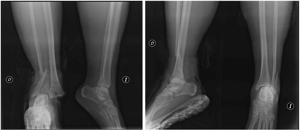 Complex Ankle Fractures, Presentation of 3 Cases and Review of the ...