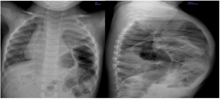 Mediastinal Lipoblastoma Causing Diaphragm Eventration - A Challenging ...