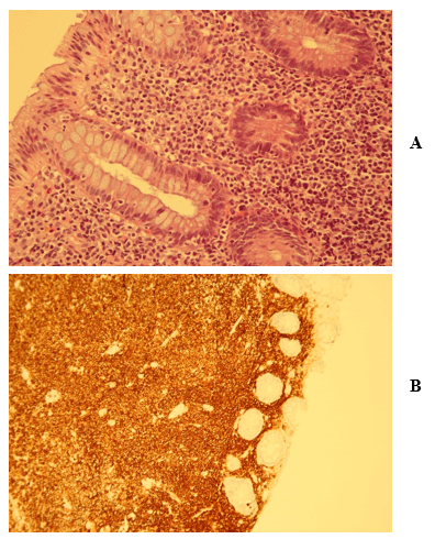 Mucosa-Associated Lymphoid-Tissue Lymphoma of the Descending Colon in a ...