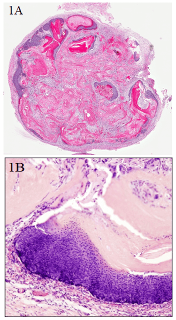Pilomatrixoma: A Case Study & Review of Literature | Surgical Case ...