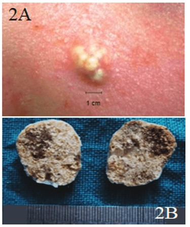 Pilomatricoma Removal