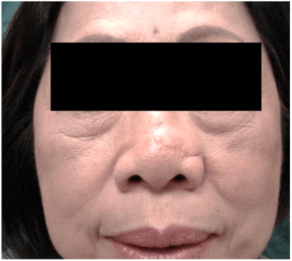 Technique for Reconstruction of Nasal Alar Defects in Asian Patients ...