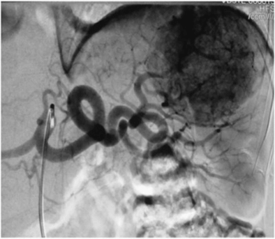 Technique for Spleen Resection Using Radiofrequency Ablation | Surgical ...