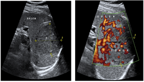 Technique for Spleen Resection Using Radiofrequency Ablation | Surgical ...