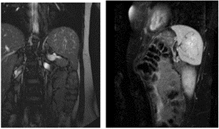 Technique for Spleen Resection Using Radiofrequency Ablation | Surgical ...