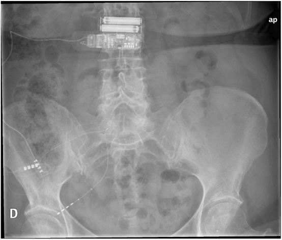 Sacral Nerve Stimulation Lead Migration through the Sciatic Foramen ...