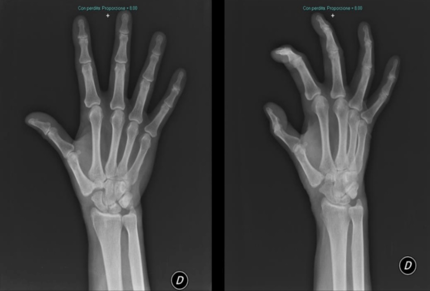 Trapeziectomy Hand Therapy Advice Following Trapeziectomy Surgery For