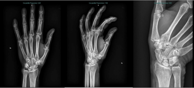 Rhizarthrosis Bilateral – Trapeziectomy Versus Arthroplasty with Dual ...