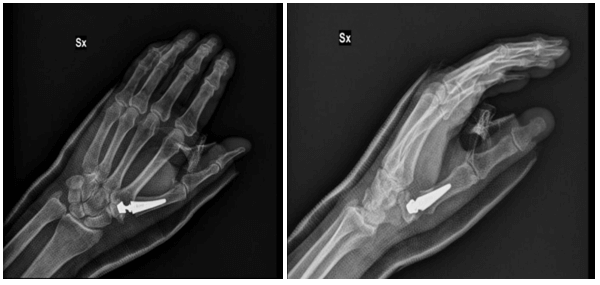 Rhizarthrosis Bilateral – Trapeziectomy Versus Arthroplasty with Dual ...