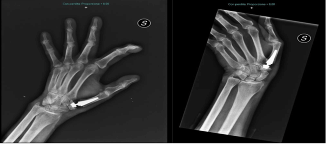Rhizarthrosis Bilateral – Trapeziectomy Versus Arthroplasty with Dual ...