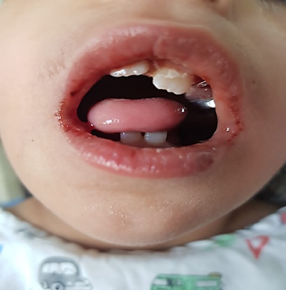Airway Challenges in Sanjad-Sakati Syndrome (SSS): A Case Report and ...