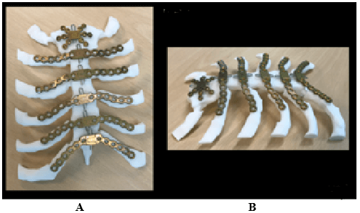Sternal Fixation with Synthes® Titanium Sternal Fixation System Using ...