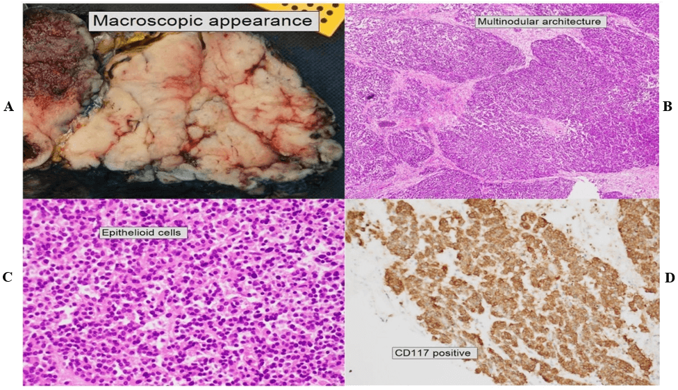 Massive Multifocal Familial GIST: A Case Report | Surgical Case Reports ...