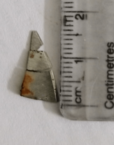 Retained Metallic Part of a Dislodged Knife in the Thoracic Spine with ...