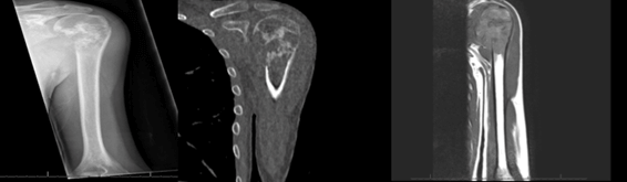 Malignancy of Aneurysmal Bone Cyst in Osteosarcoma and Angiosarcoma ...
