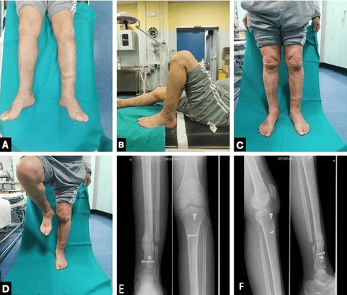 Septic Tibial Shaft Non-Union Treated by One-Step Surgery Using a ...